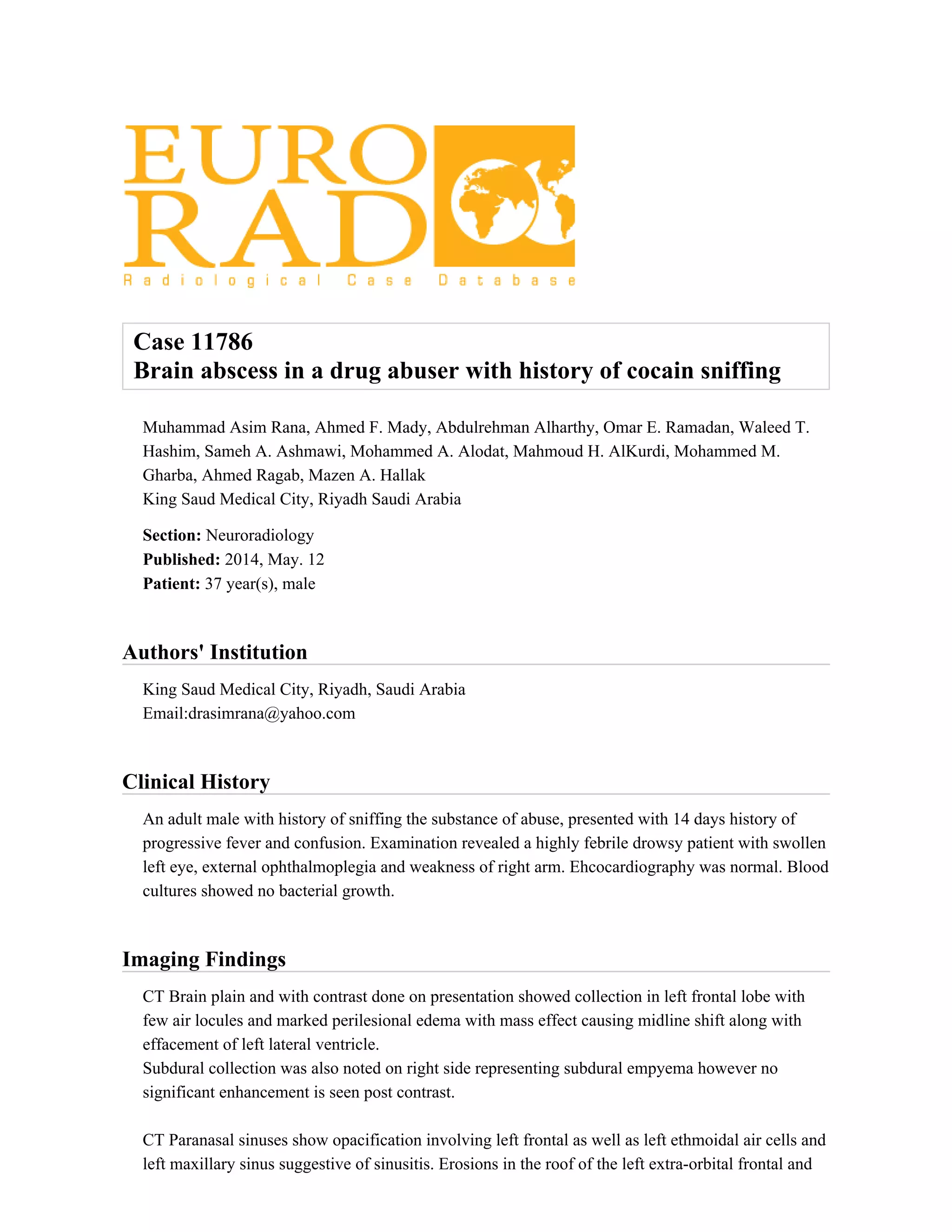 Brain abcess case | PDF