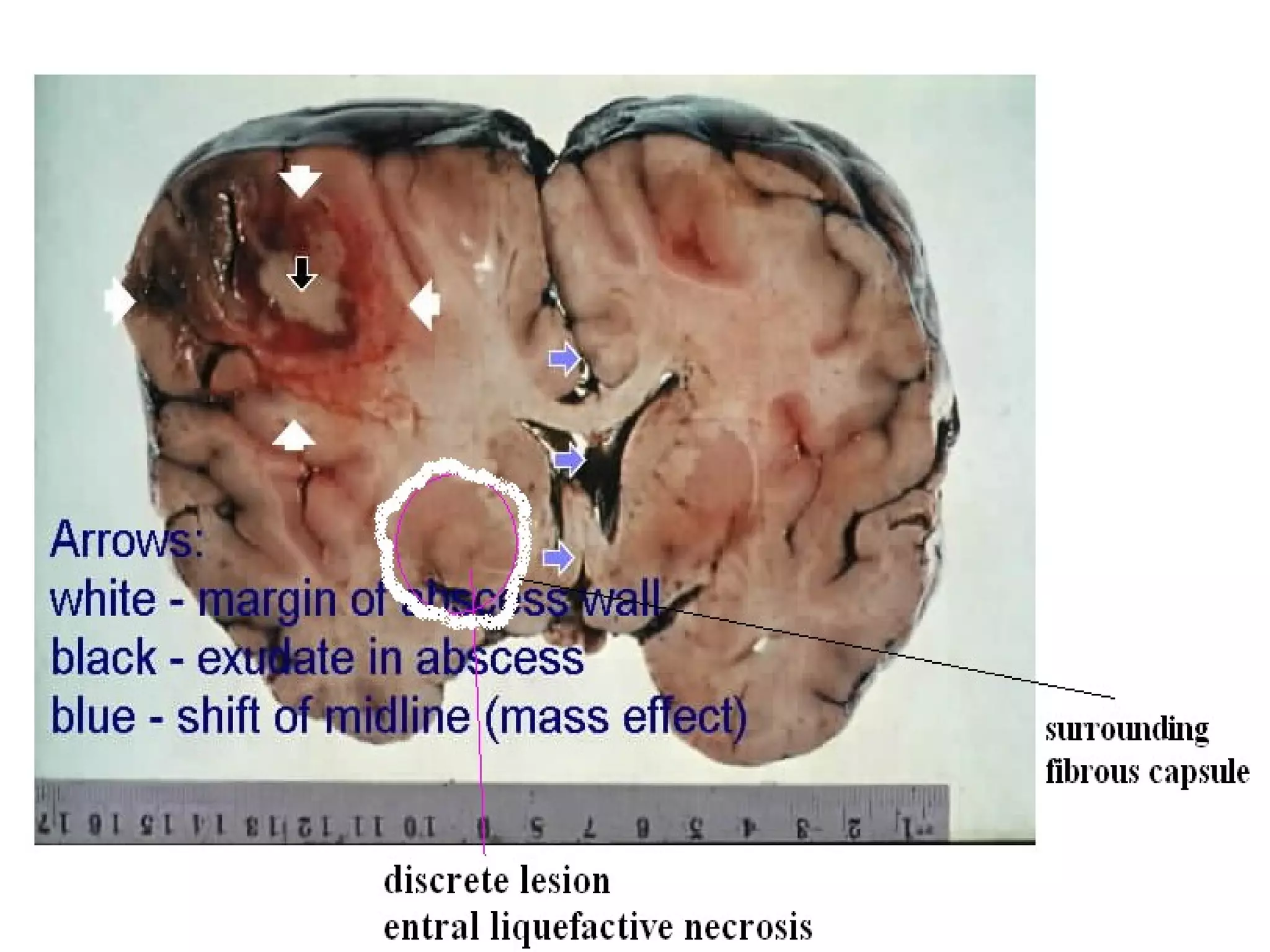 Brain abscess | PPT