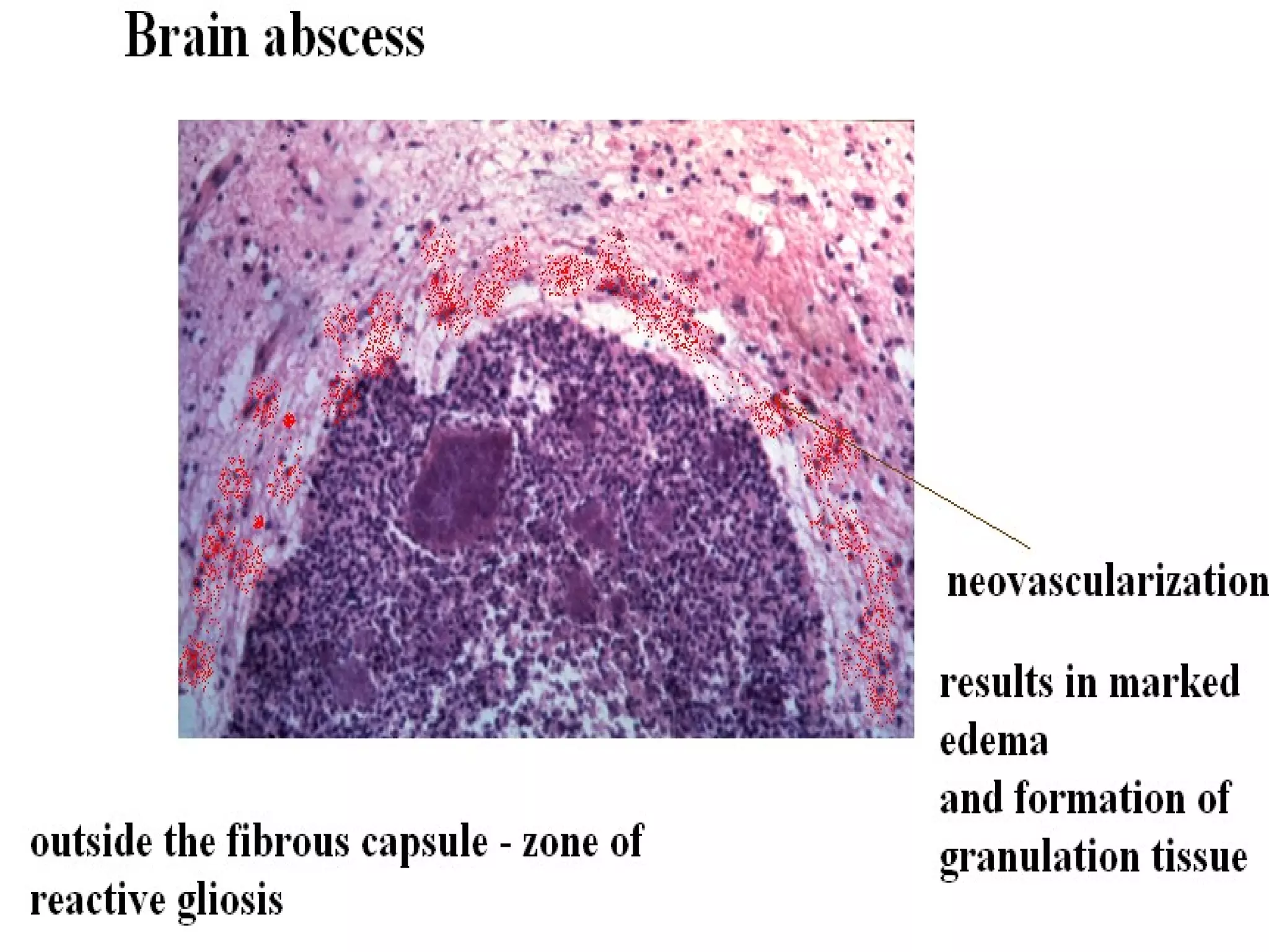 Brain abscess | PPT