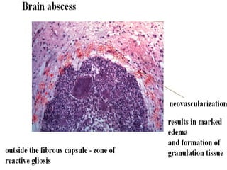 Brain abscess | PPT
