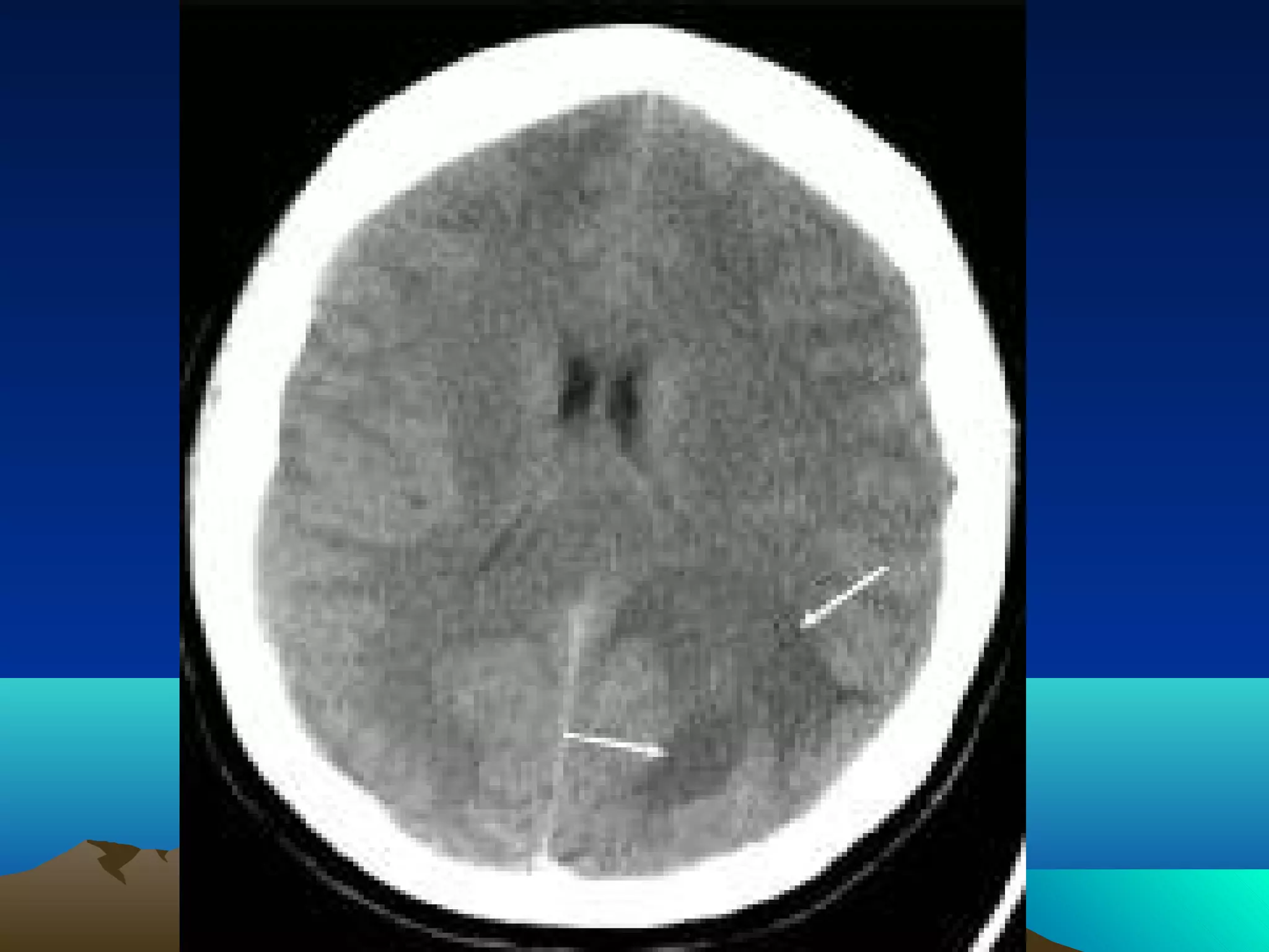 Brain abscess | PPT