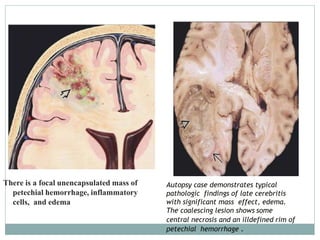 Brain abscess by waheed | PPT