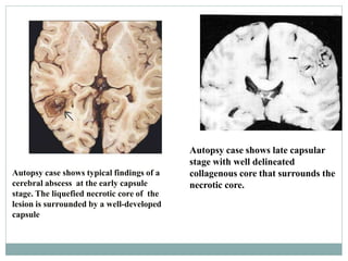 Brain abscess by waheed | PPT