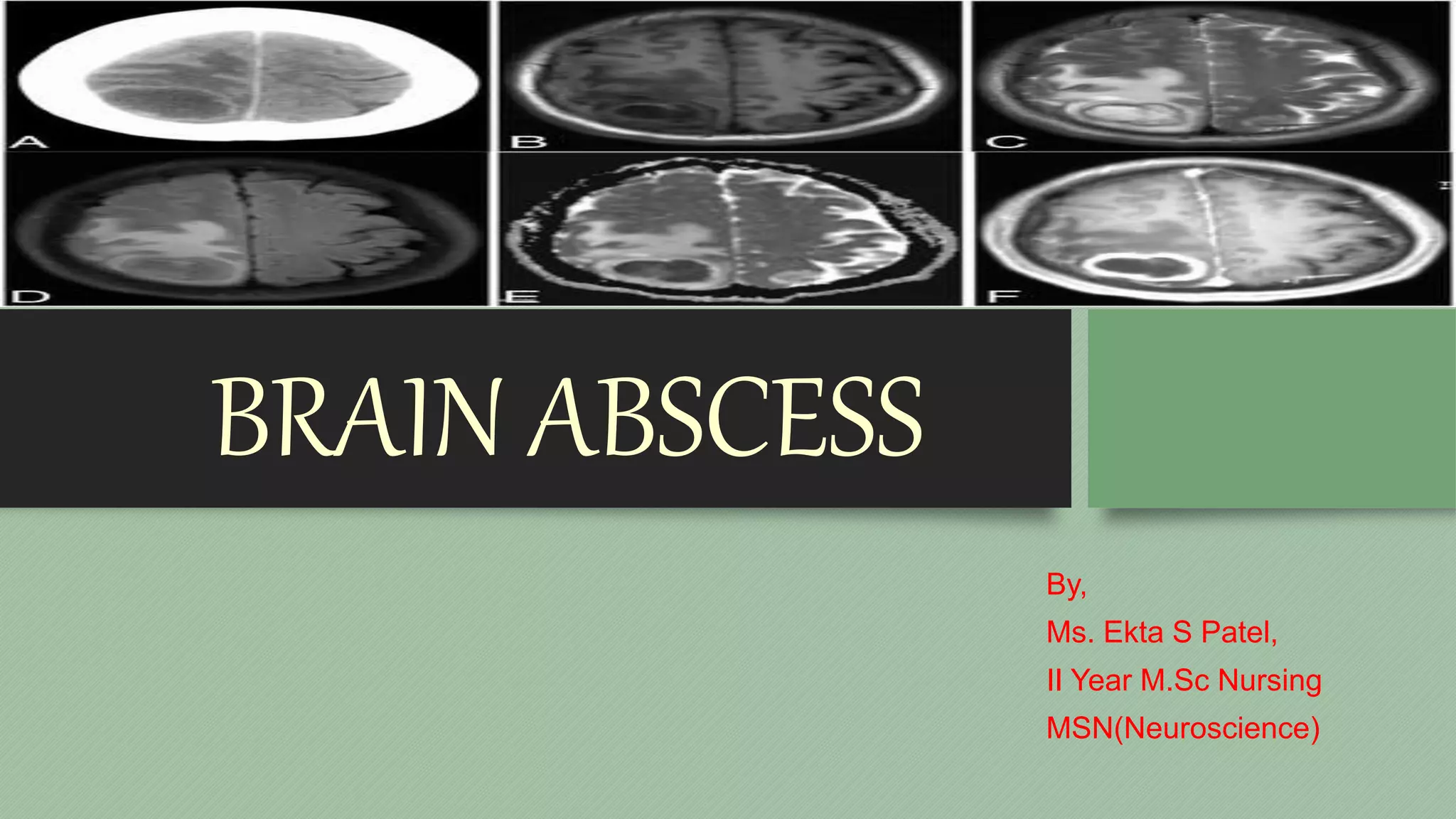 Encephalitis Mri