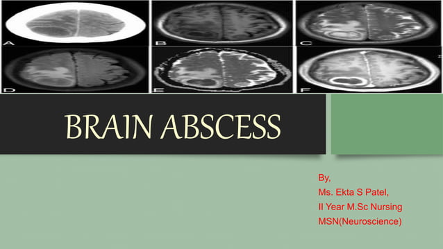 Brain abscess | PPTX | Brain and Nervous System Disorders | Diseases ...