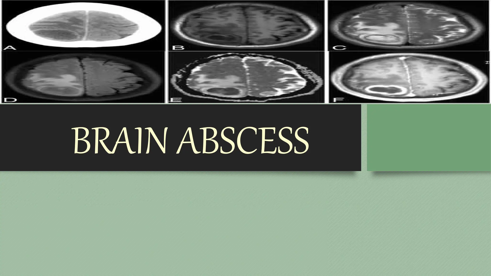 brain abscess, signs and symptoms, diagnostic tests, c/f. | PPTX