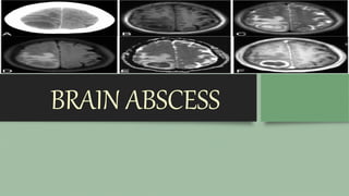 brain abscess, signs and symptoms, diagnostic tests, c/f. | PPTX
