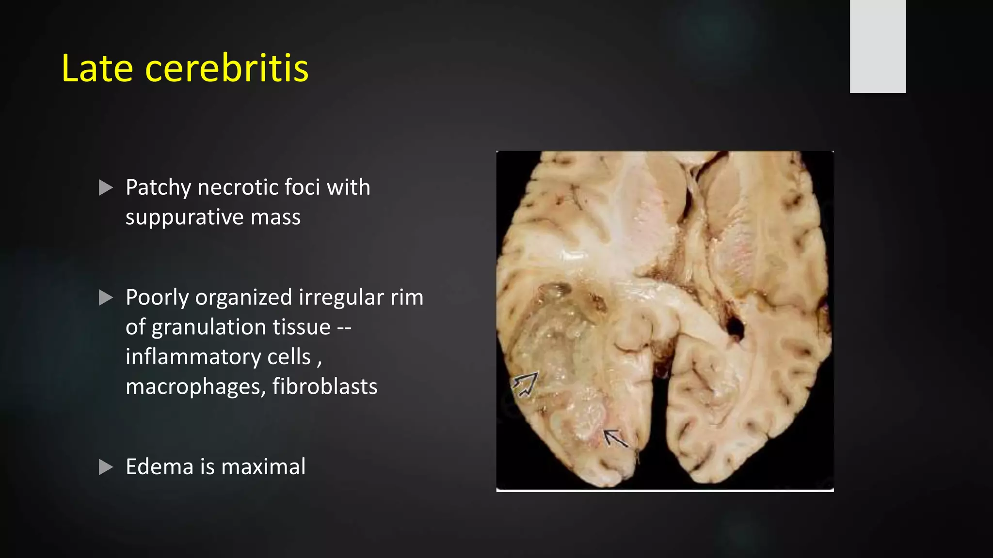 Brain abscess | PPTX