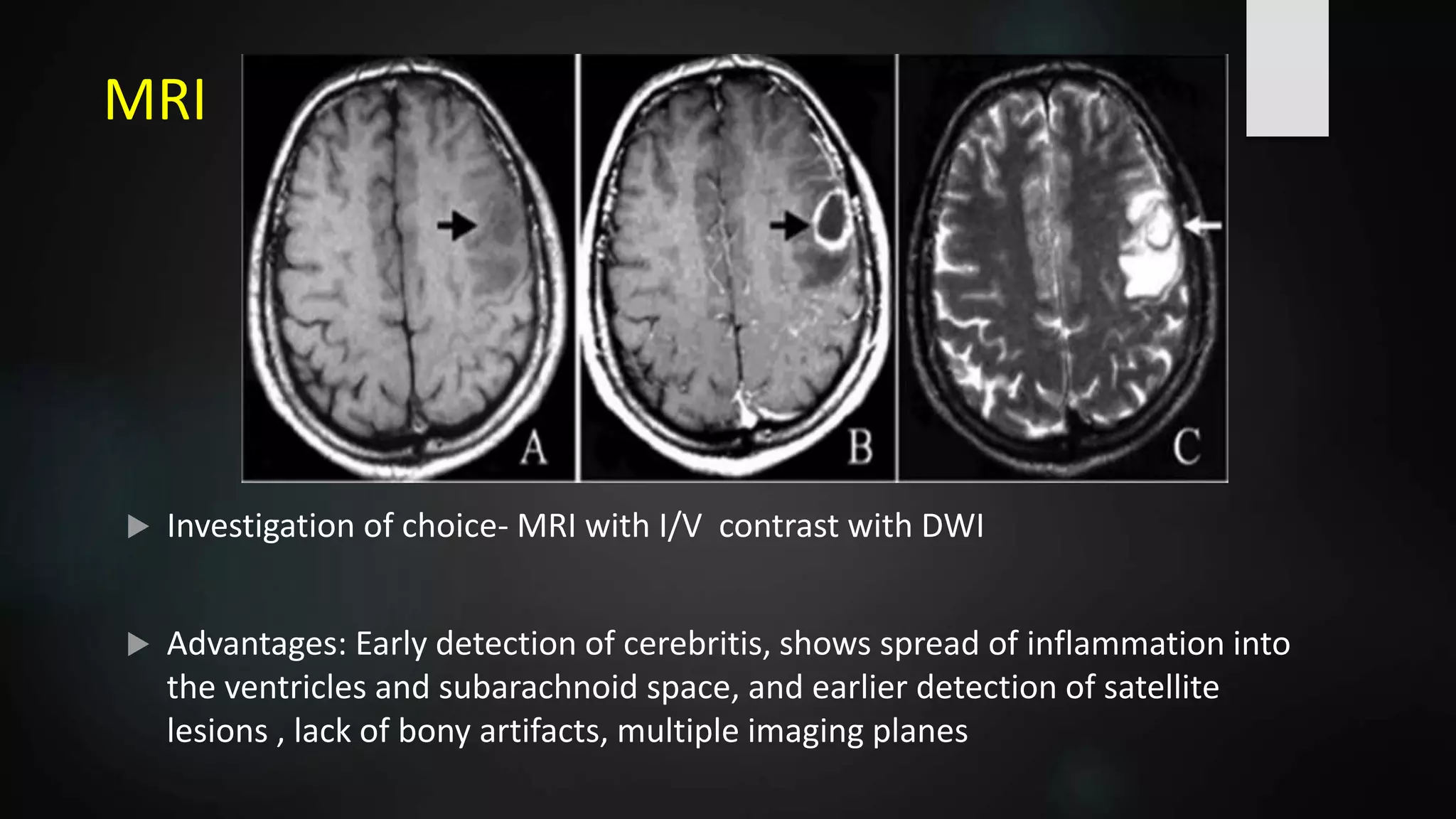 Brain abscess | PPTX