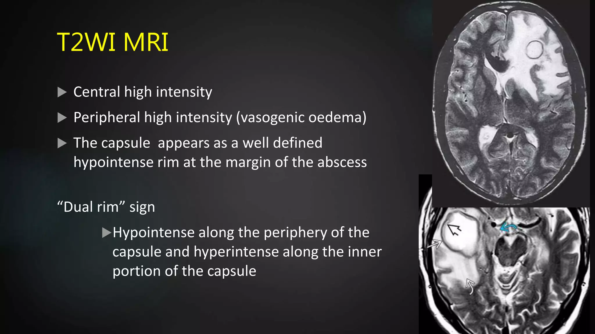 Brain abscess | PPTX
