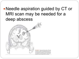Brain abscess | PPTX