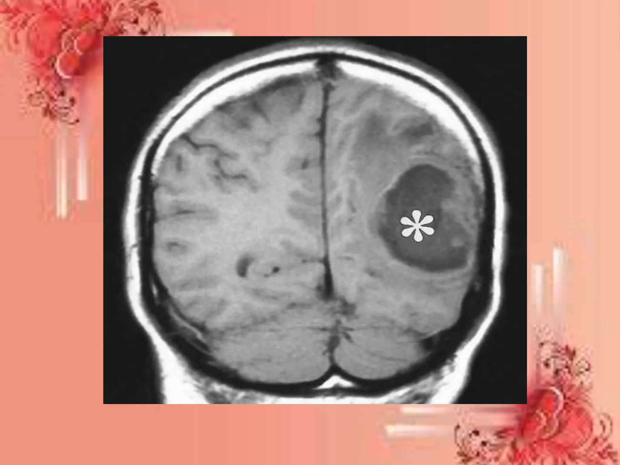 BRAIN ABSCESS.pptx