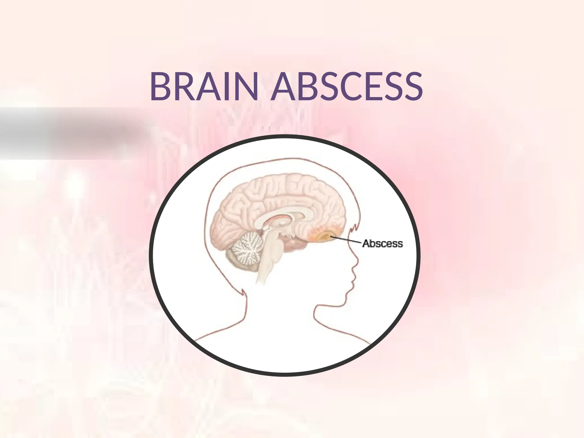 BRAIN ABSCESS.pptx dsgswgewgwhtRGTWGRGRDT | PPTX