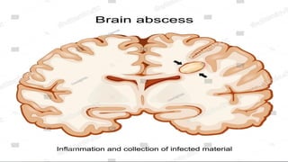 Brain Abscess presentation Adult health Nursing-II.pptx