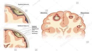 Brain Abscess presentation Adult health Nursing-II.pptx