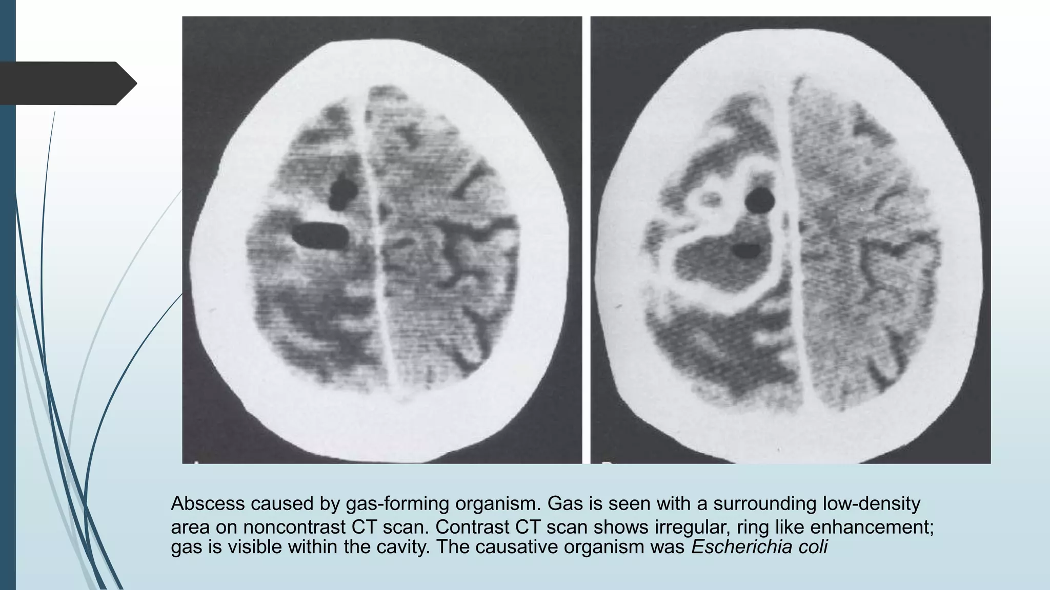 Brain abscess (dr. mahesh) | PPTX