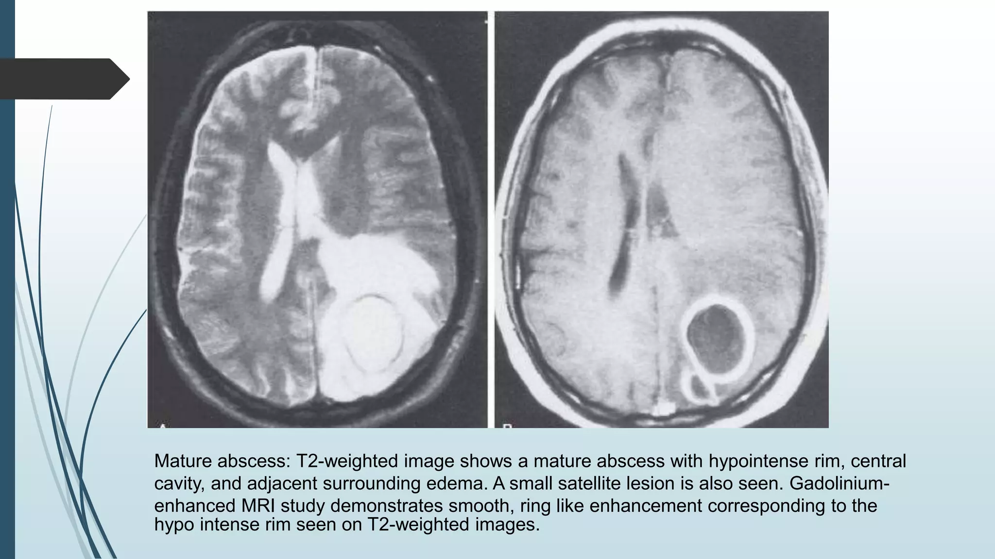 Brain abscess (dr. mahesh) | PPTX