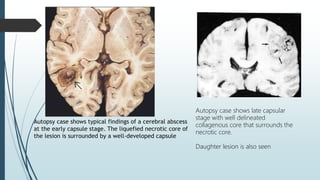 Brain abscess (dr. mahesh) | PPTX