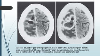 Brain abscess (dr. mahesh) | PPTX