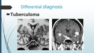 Brain abscess (dr. mahesh) | PPTX