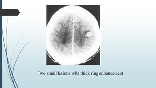 Brain abscess (dr. mahesh) | PPTX