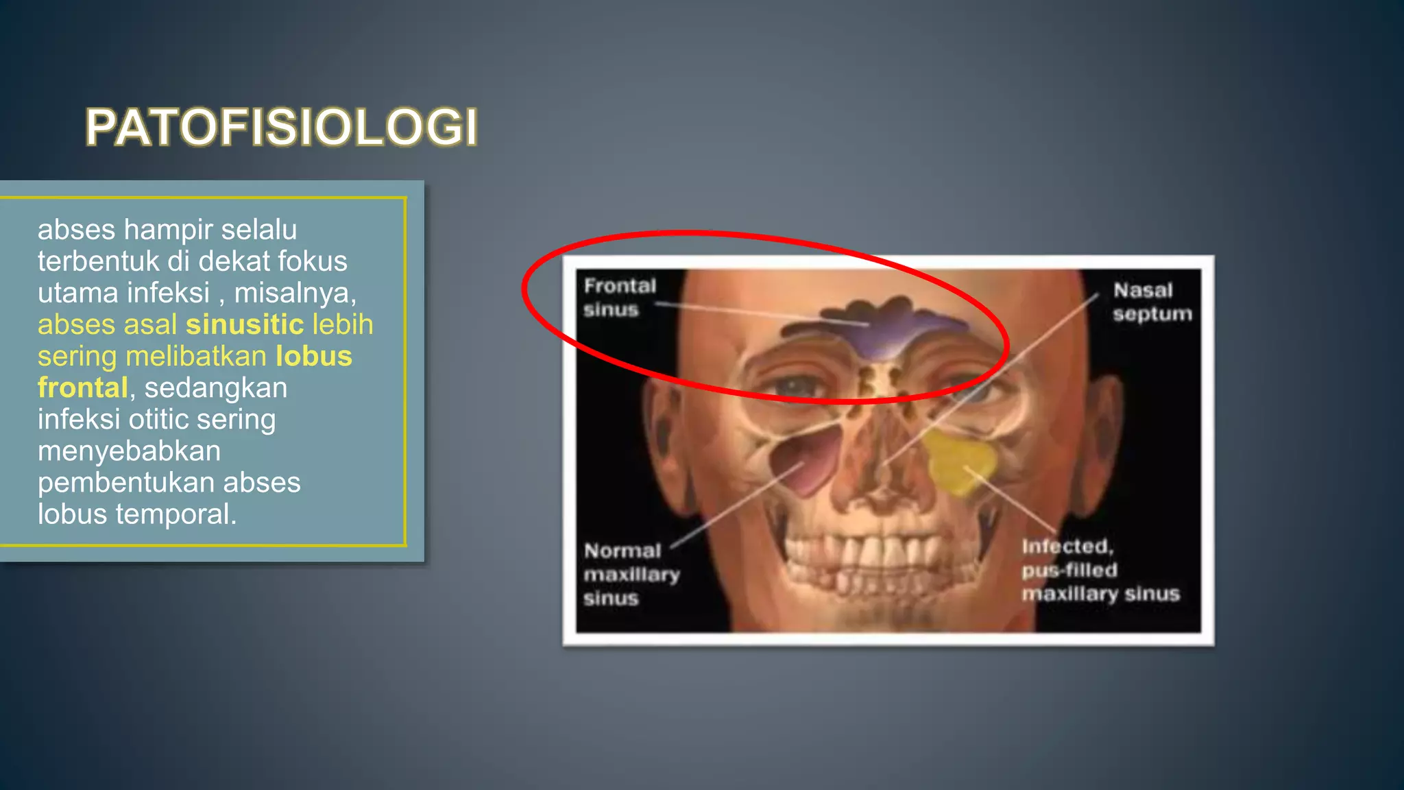 Brain abscess ec sinusitis | PPTX