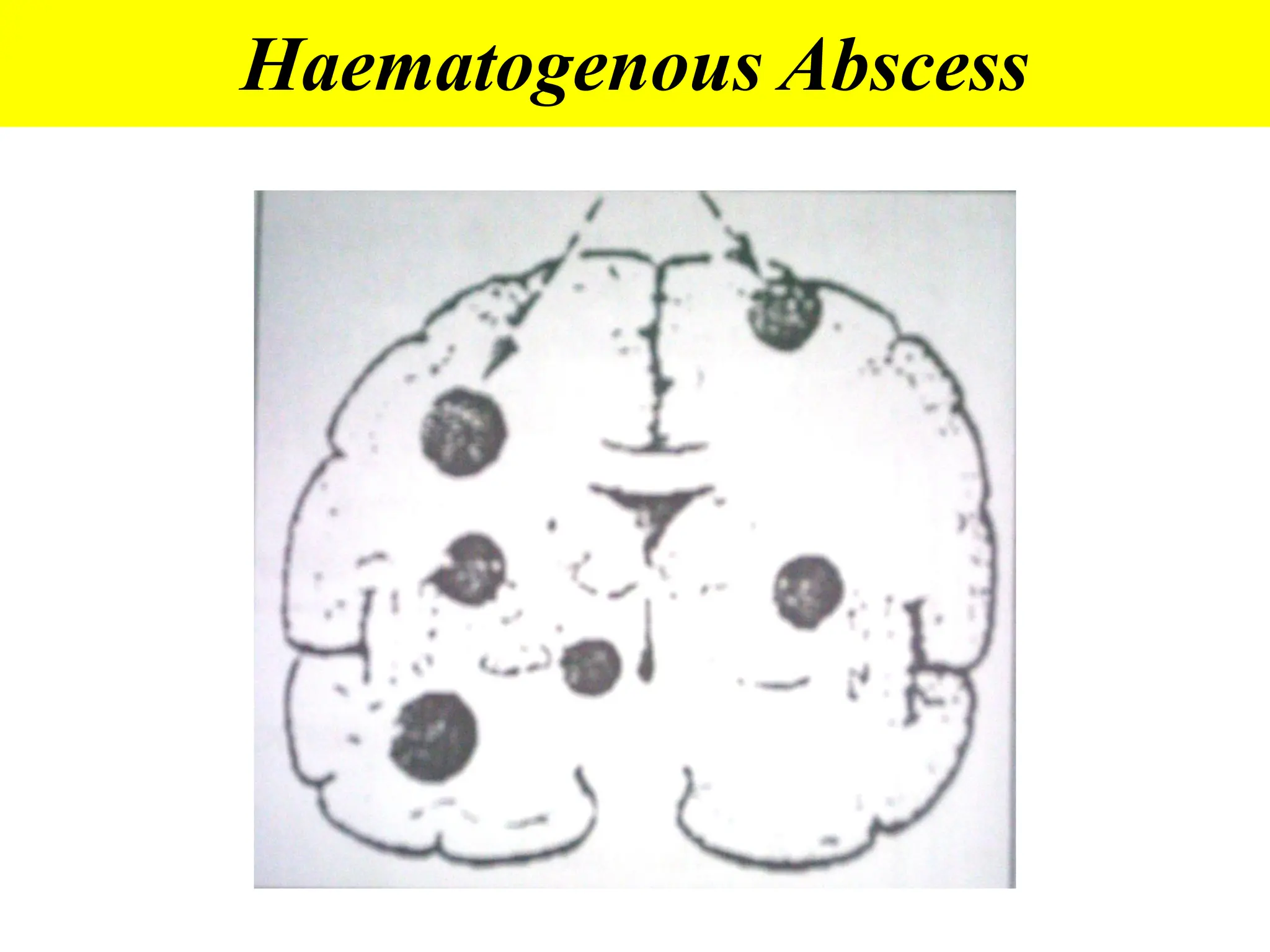 Brain Abscess it's causes and treatment and sign symptoms | PDF
