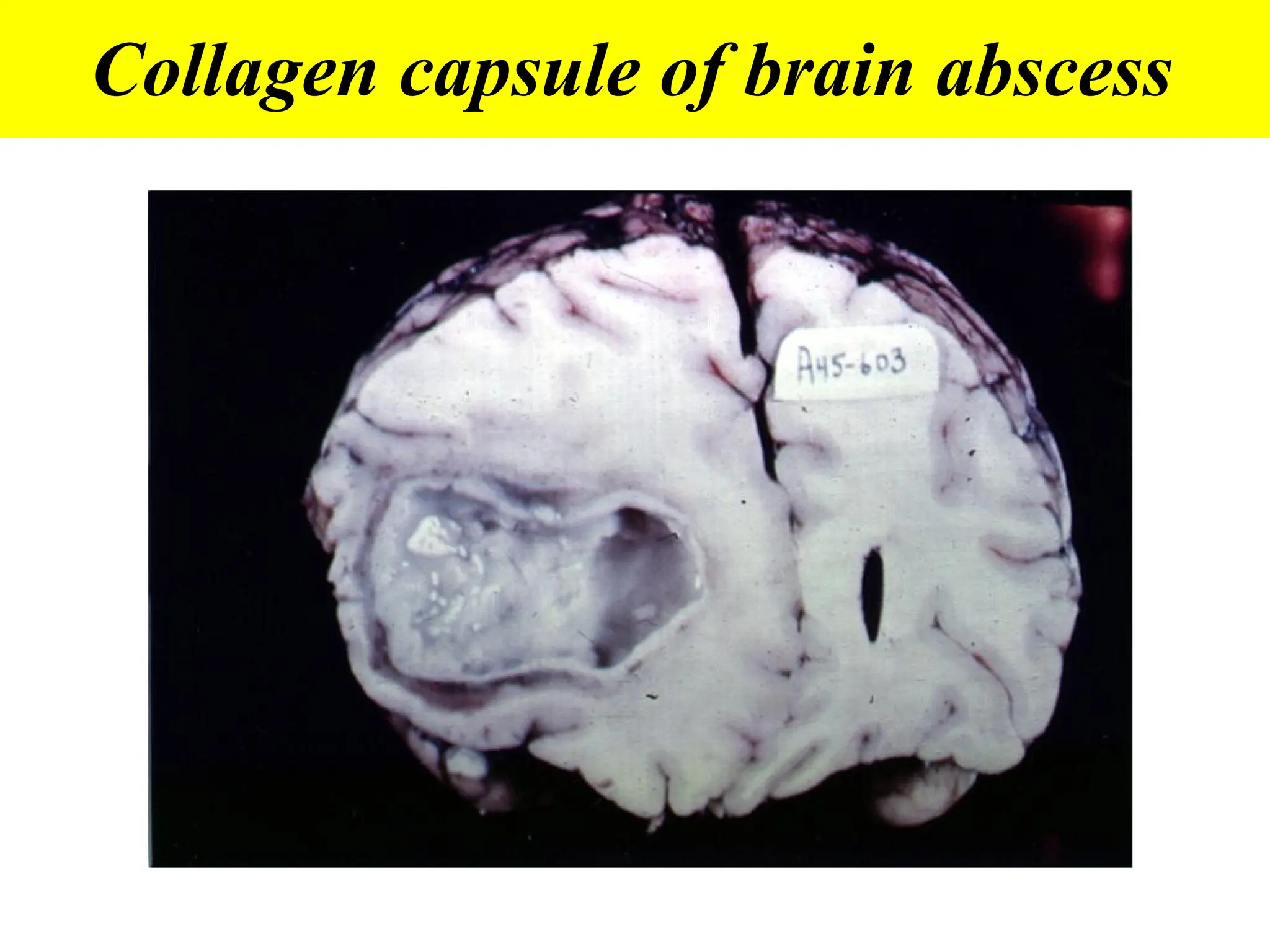 Brain Abscess it's causes and treatment and sign symptoms | PDF