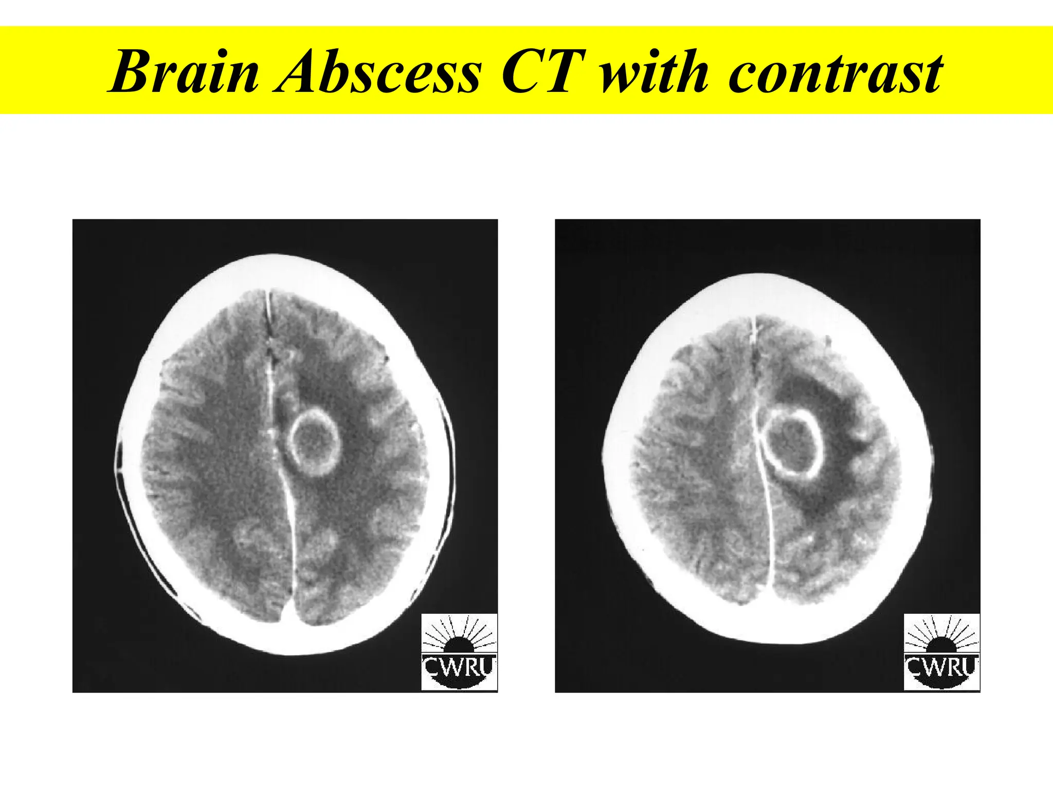 Brain Abscess it's causes and treatment and sign symptoms | PDF