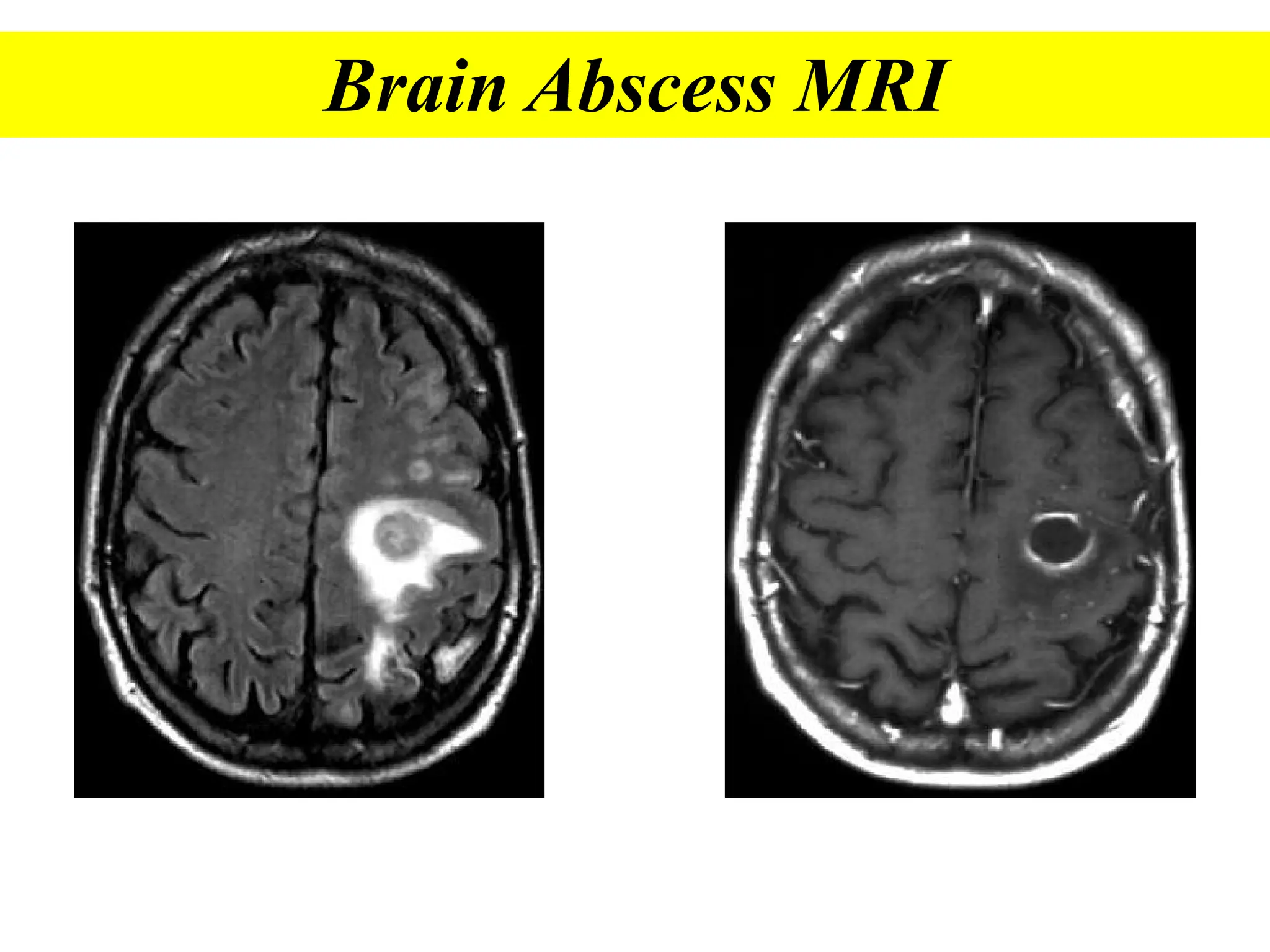 Brain Abscess it's causes and treatment and sign symptoms | PDF