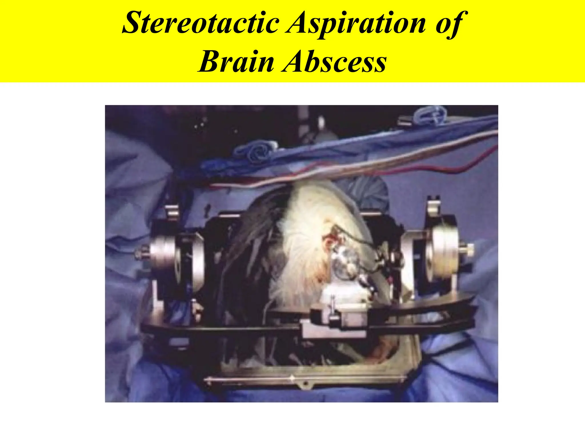 Brain Abscess it's causes and treatment and sign symptoms | PDF