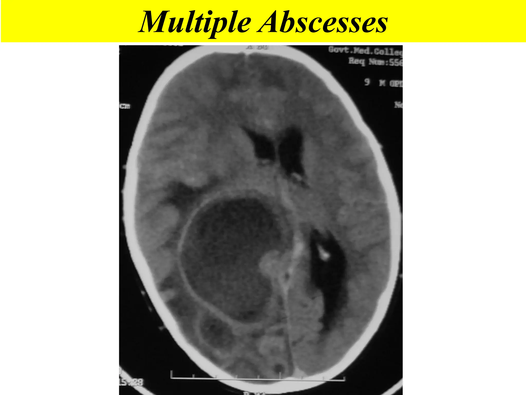 Brain Abscess it's causes and treatment and sign symptoms | PDF