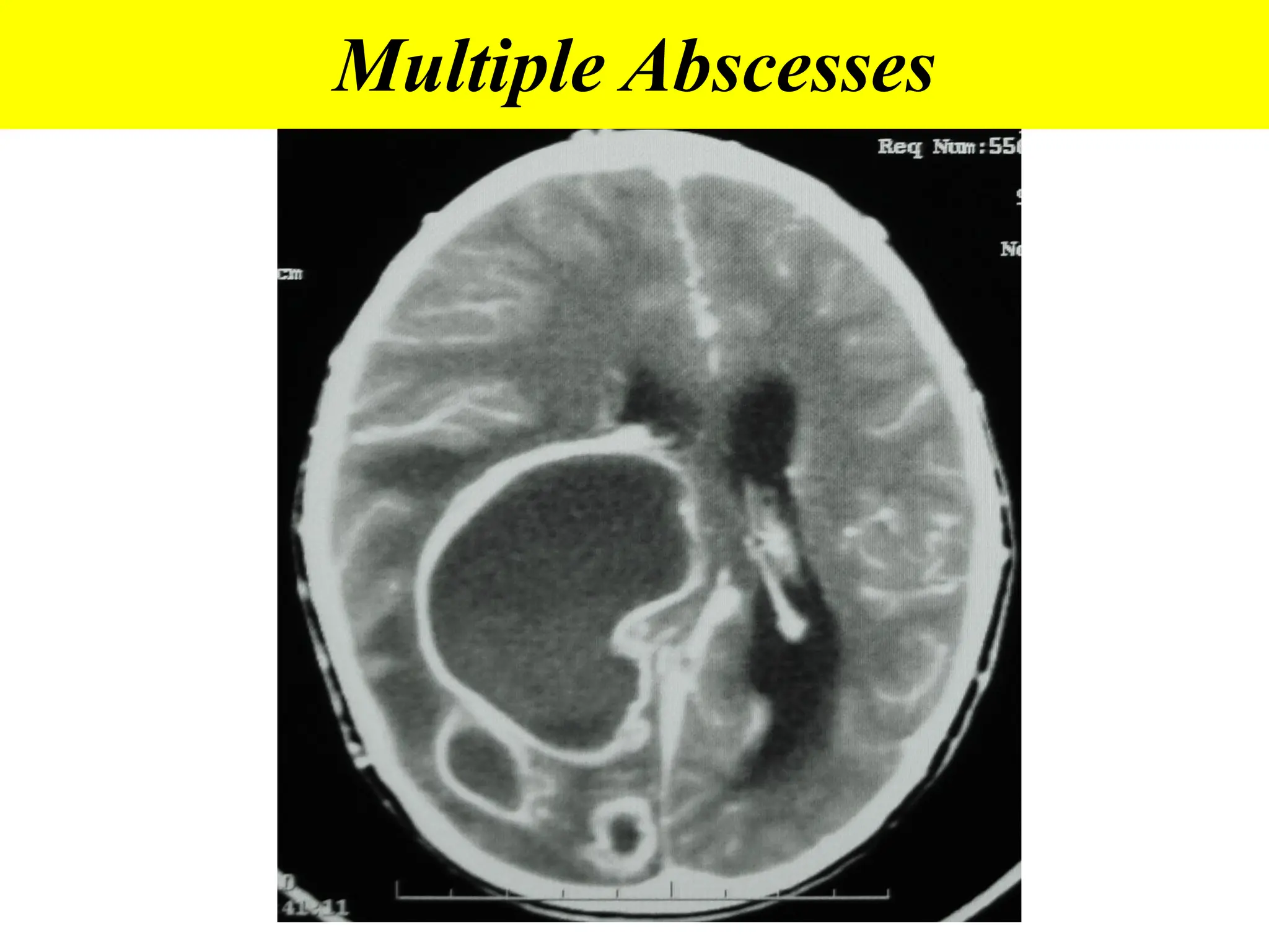 Brain Abscess it's causes and treatment and sign symptoms | PDF