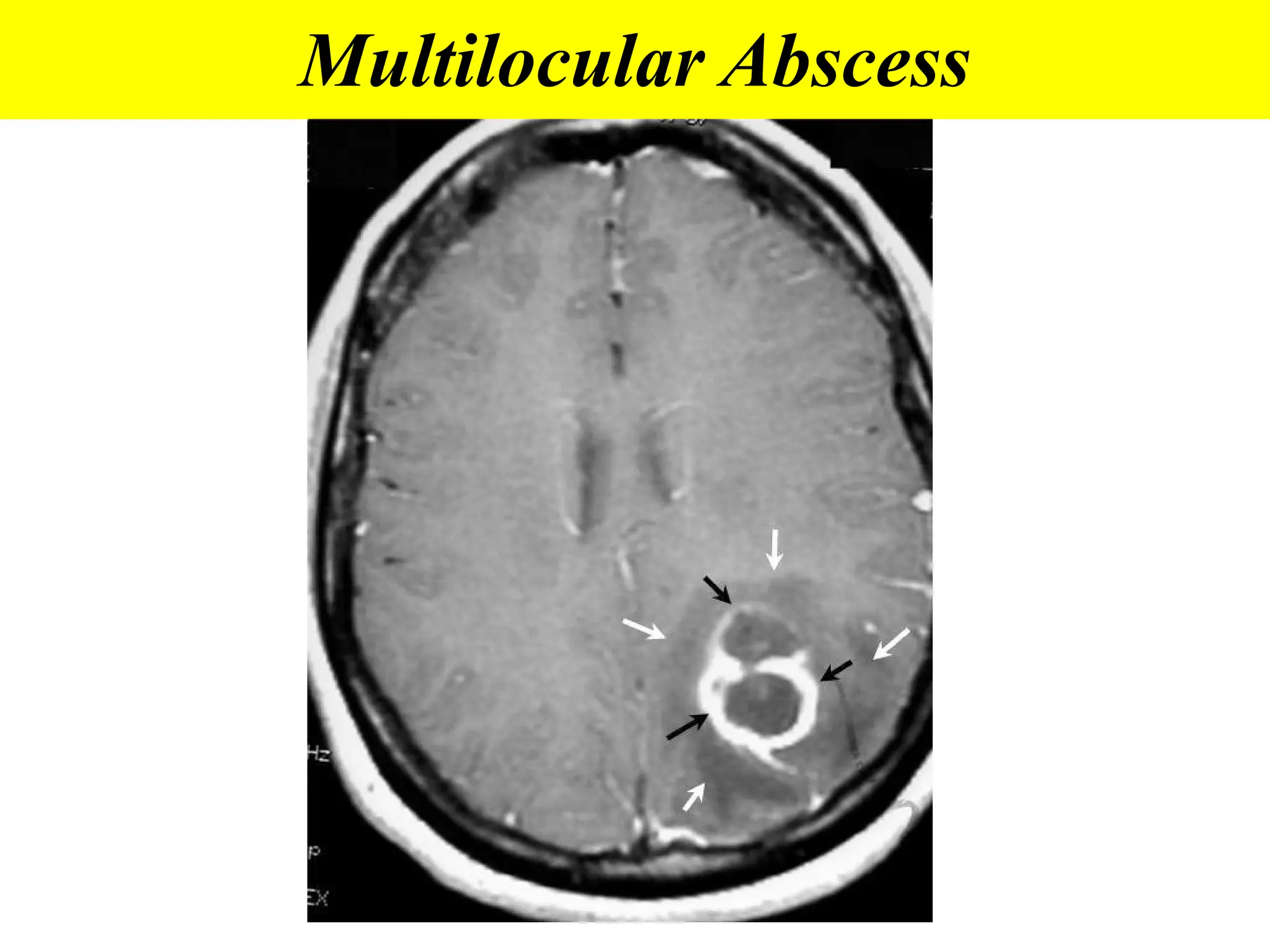 Brain Abscess it's causes and treatment and sign symptoms | PDF
