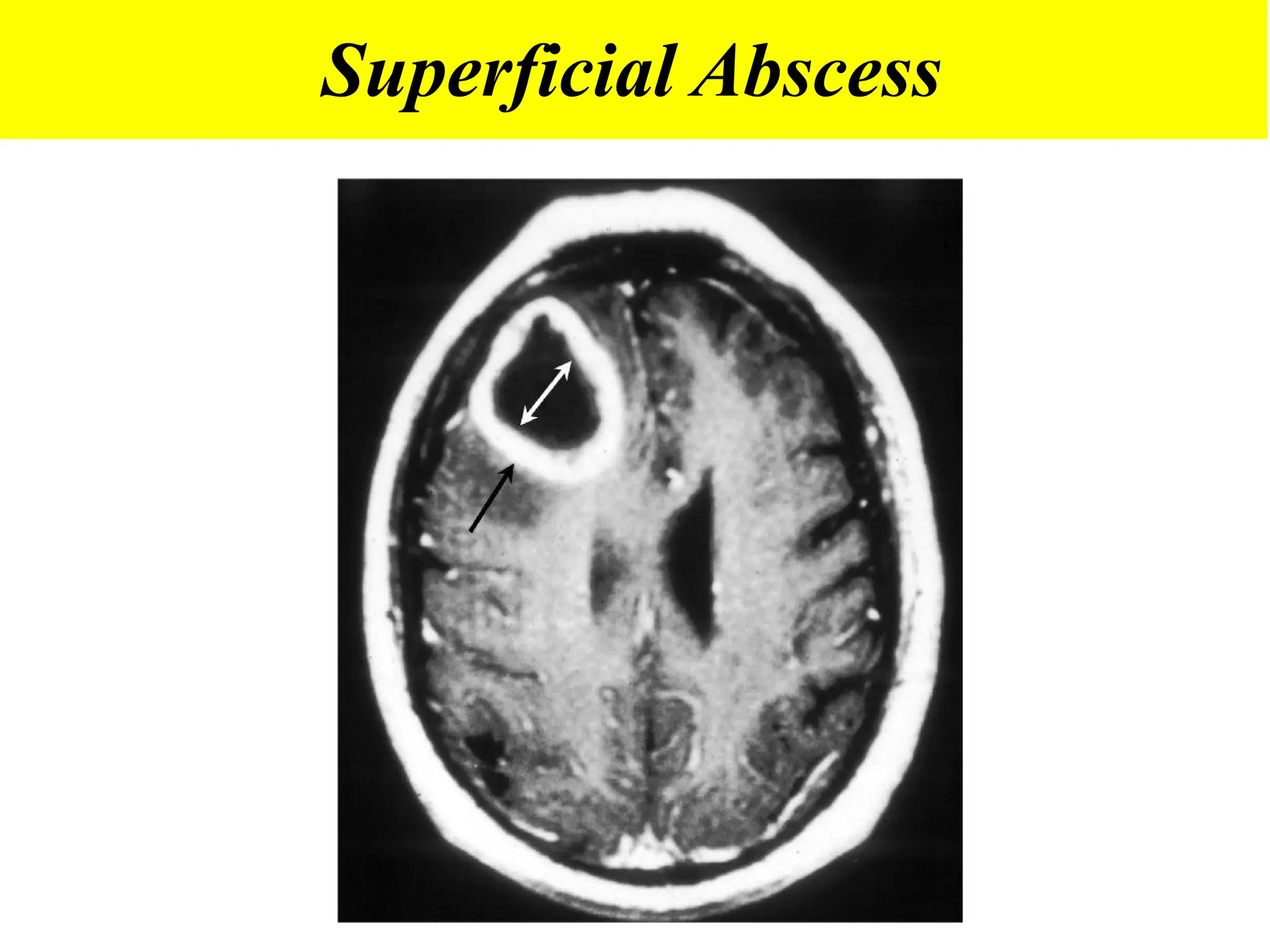 Brain Abscess it's causes and treatment and sign symptoms | PDF
