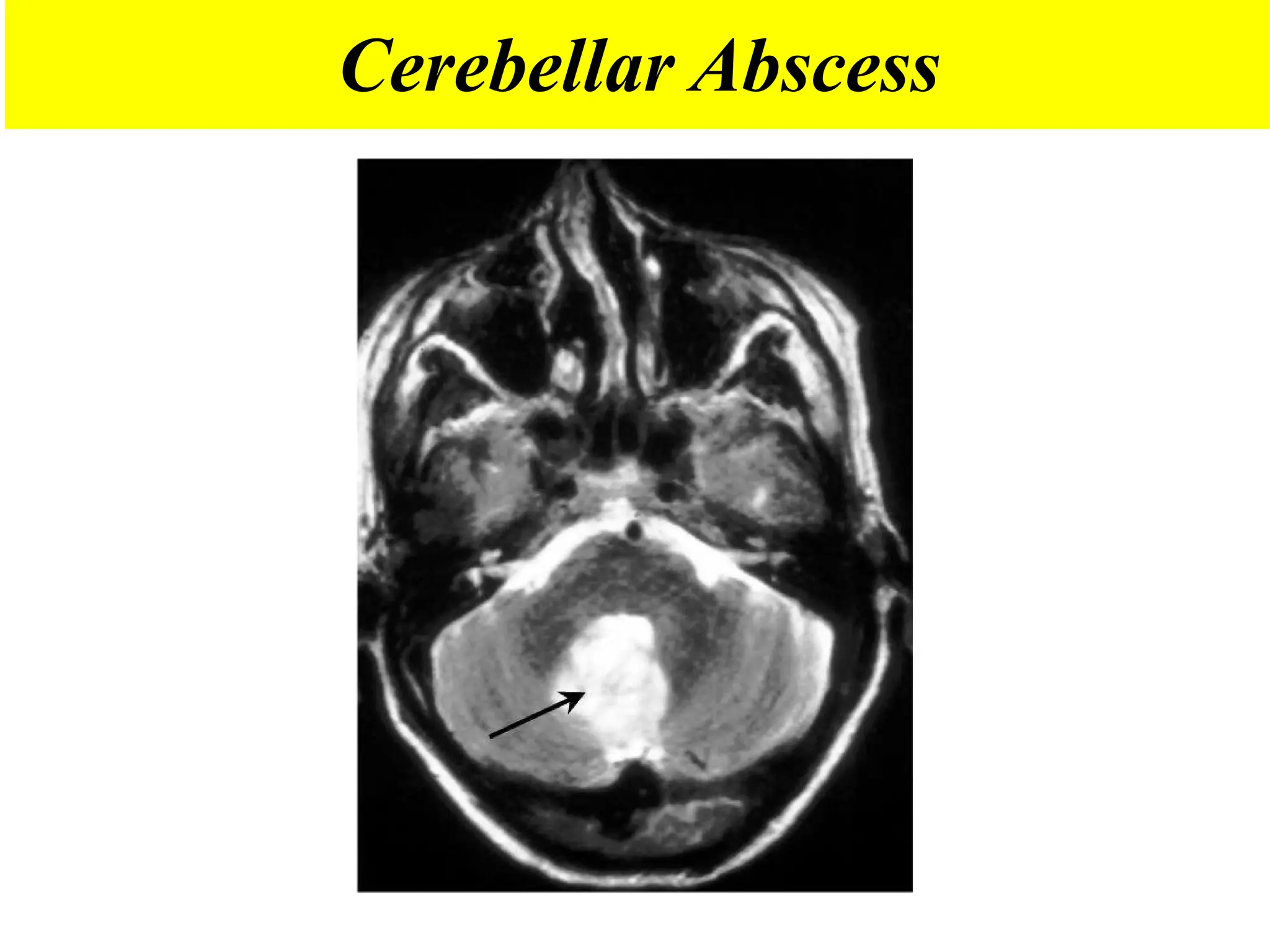 Brain Abscess it's causes and treatment and sign symptoms | PDF