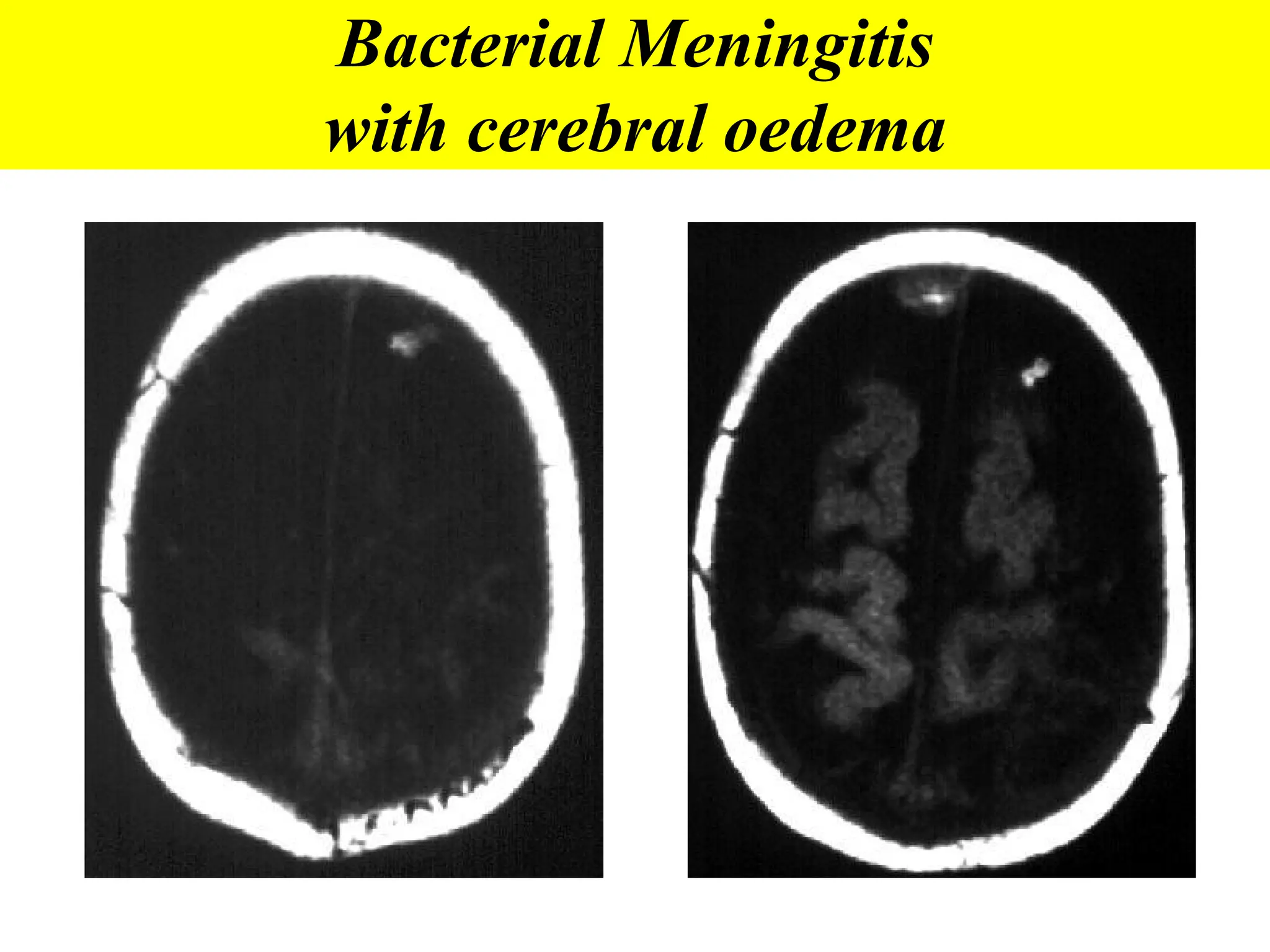 Brain Abscess it's causes and treatment and sign symptoms | PDF