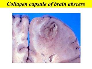 Brain Abscess it's causes and treatment and sign symptoms | PDF