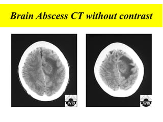Brain Abscess it's causes and treatment and sign symptoms | PDF