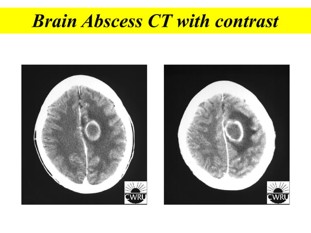 Brain Abscess it's causes and treatment and sign symptoms | PDF