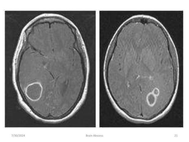 brain abscess explained in details, management | PPTX | Ear, Nose and ...