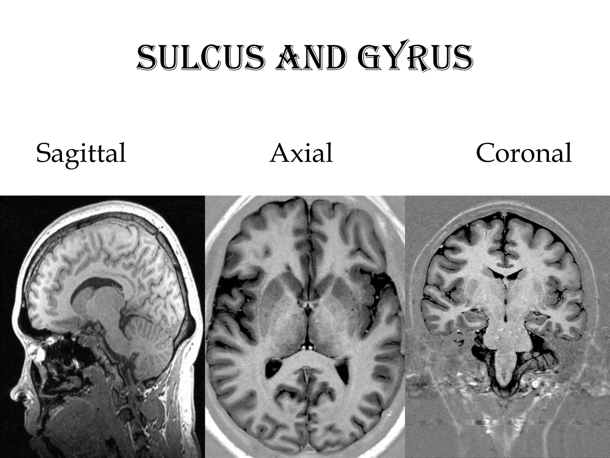 Anatomy of brain sulcus and gyrus - Dr.Sajith MD RD | PPTX