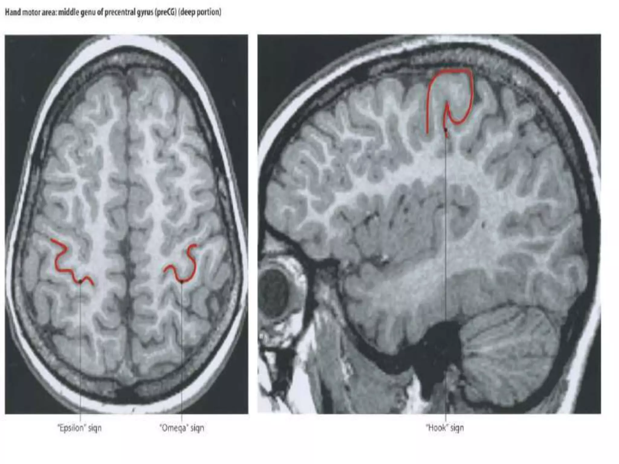 Anatomy of brain sulcus and gyrus - Dr.Sajith MD RD | PPTX