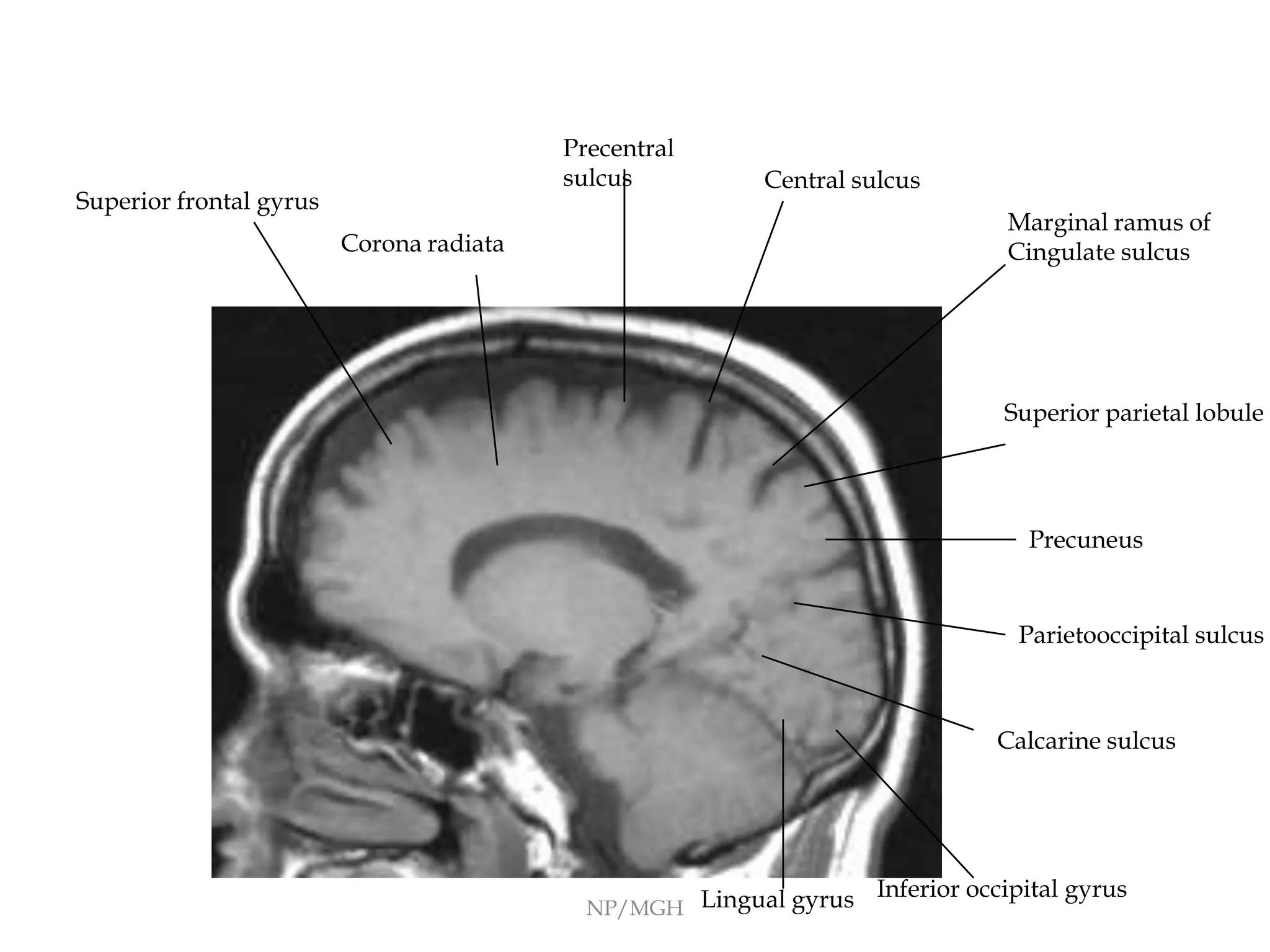 Anatomy of brain sulcus and gyrus - Dr.Sajith MD RD | PPTX