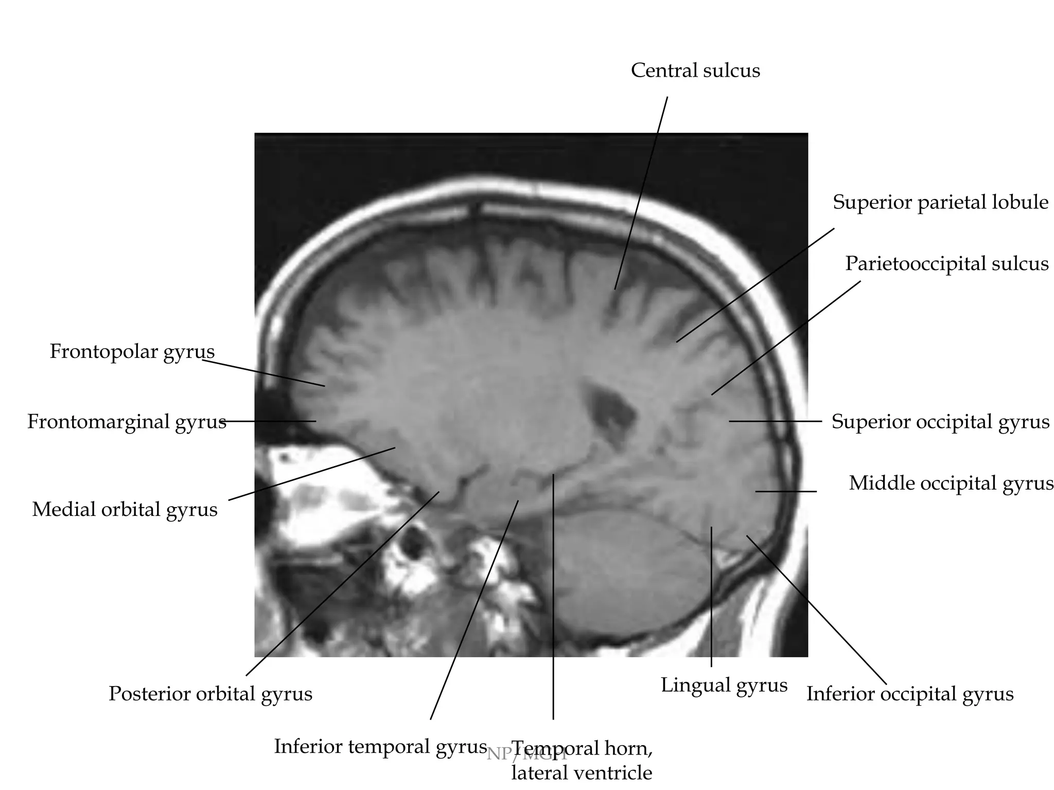 Anatomy of brain sulcus and gyrus - Dr.Sajith MD RD | PPTX