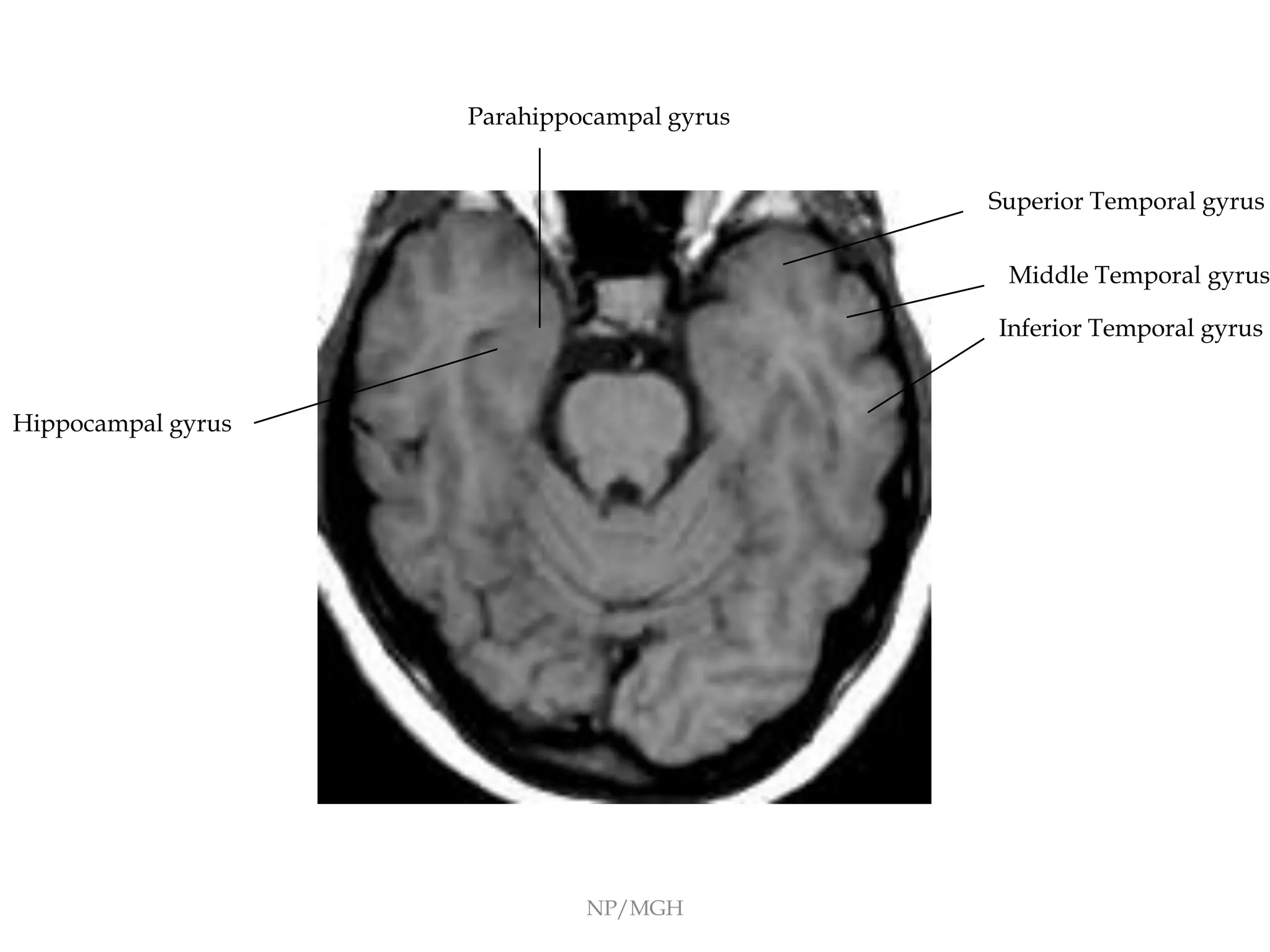 Anatomy of brain sulcus and gyrus - Dr.Sajith MD RD | PPTX