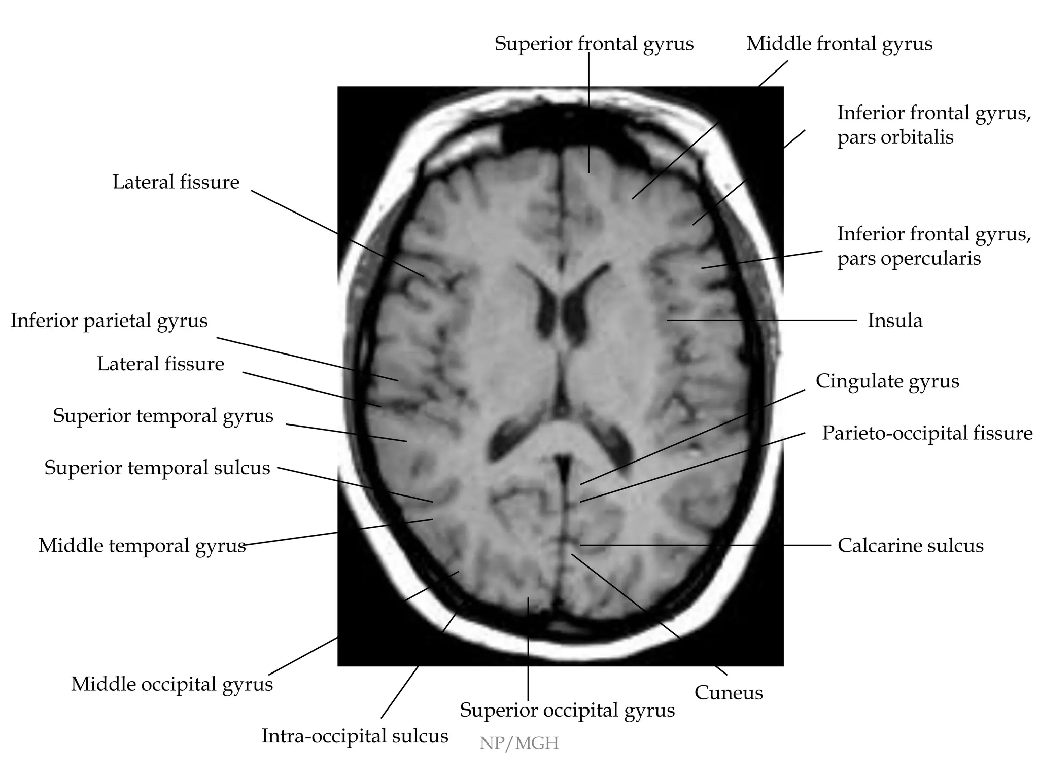 Anatomy of brain sulcus and gyrus - Dr.Sajith MD RD | PPTX