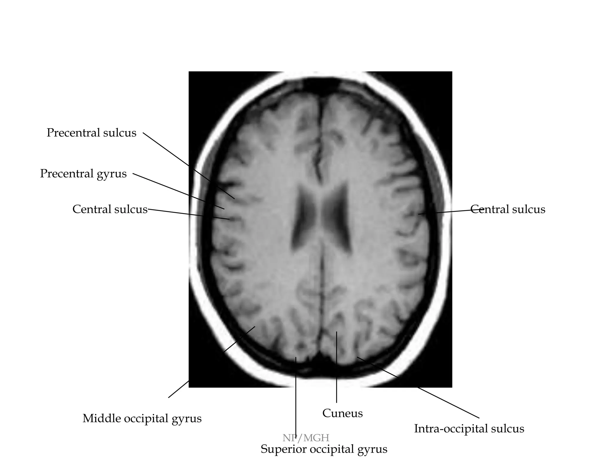 Anatomy of brain sulcus and gyrus - Dr.Sajith MD RD | PPTX