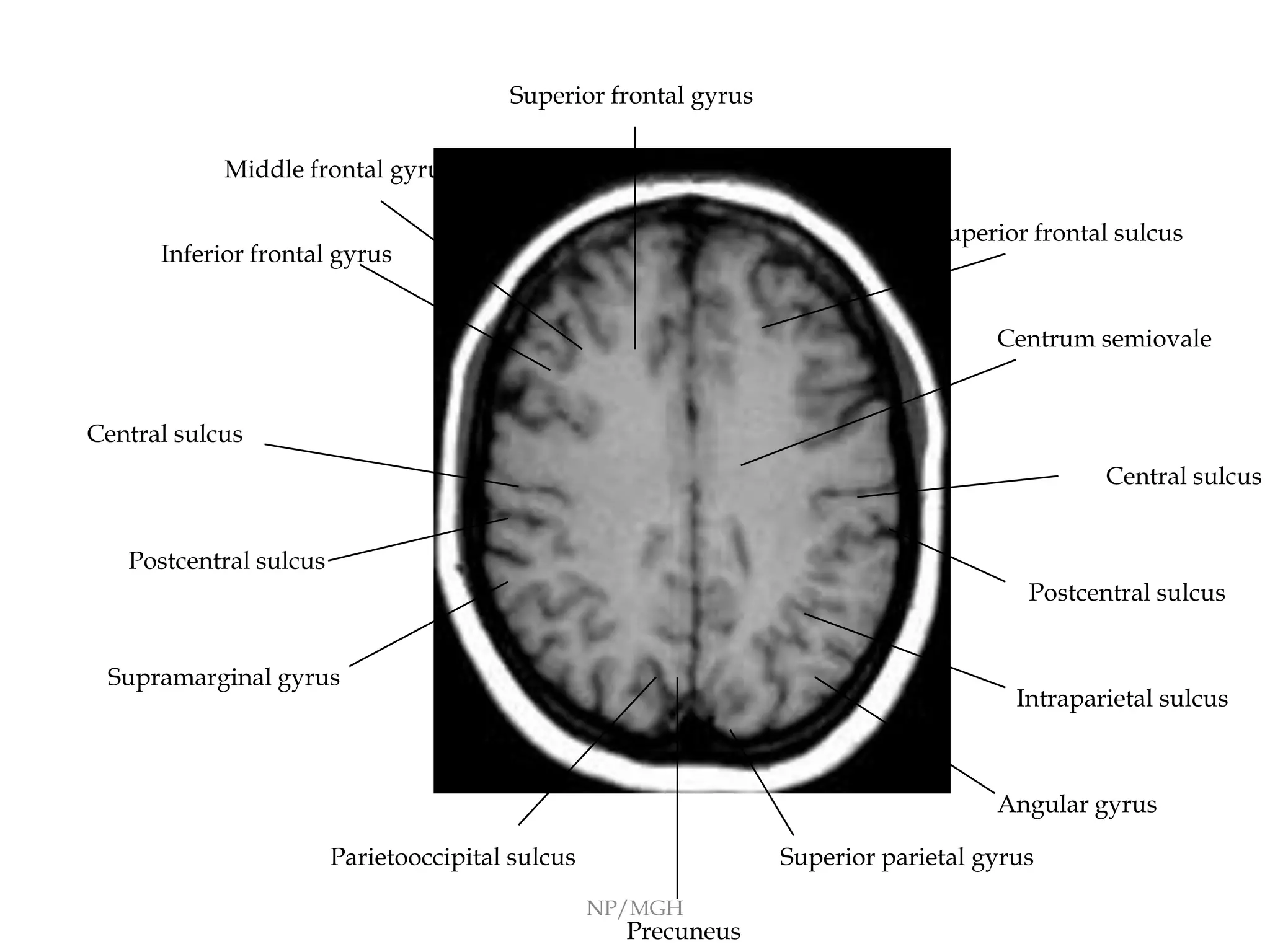 Anatomy of brain sulcus and gyrus - Dr.Sajith MD RD | PPTX