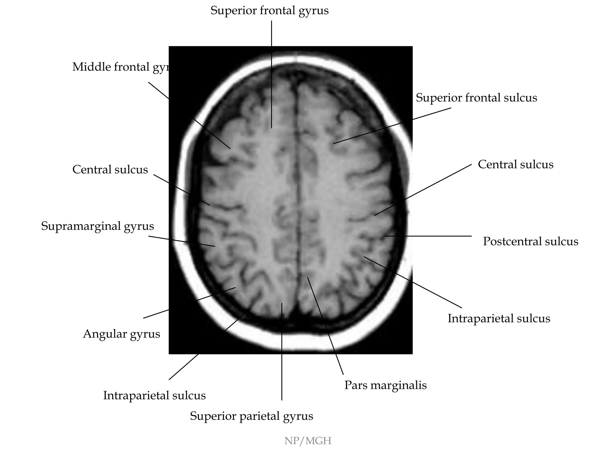 Anatomy of brain sulcus and gyrus - Dr.Sajith MD RD | PPTX